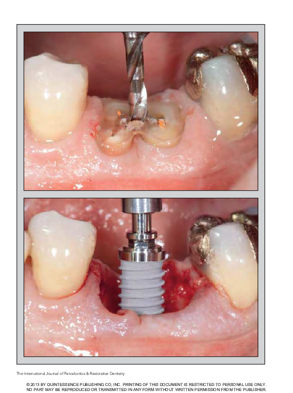 (PDF) Pre-extractive Interradicular Implant Bed Preparation: Case Presentations of a Novel ...