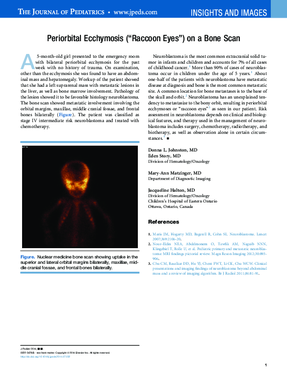 (PDF) Periorbital Ecchymosis (“Raccoon Eyes”) on a Bone Scan ...