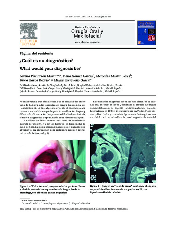 (PDF) Quiste dermoide congénito en suelo de boca
