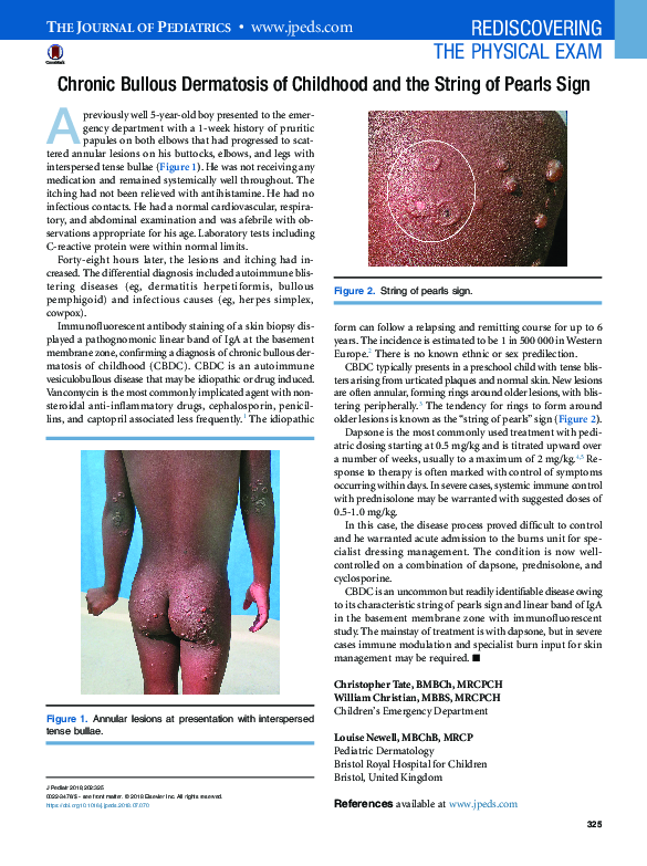 (PDF) Chronic Bullous Dermatosis of Childhood and the String of Pearls Sign
