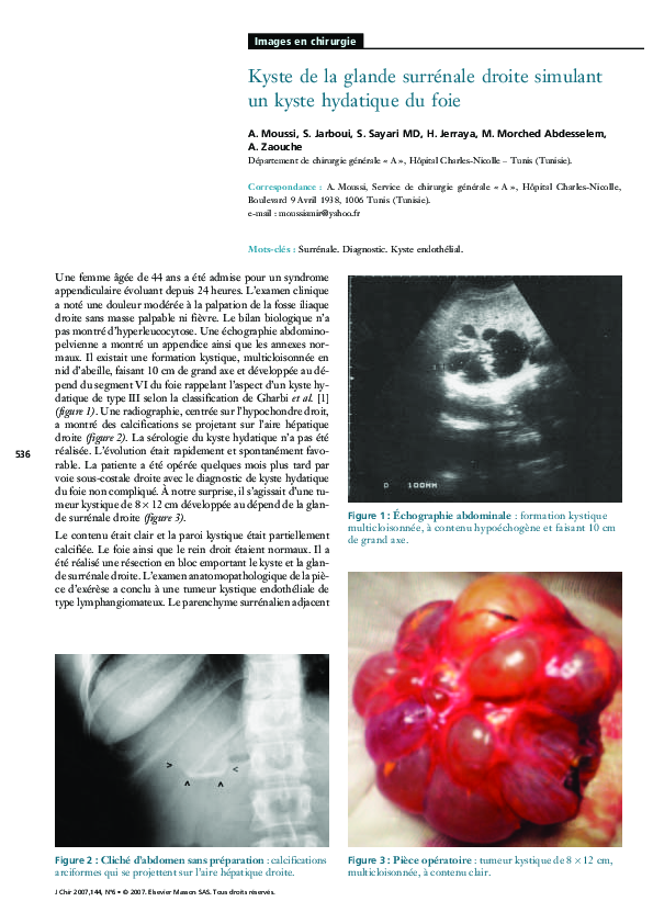 (PDF) Kyste de la glande surrénale droite simulant un kyste hydatique ...