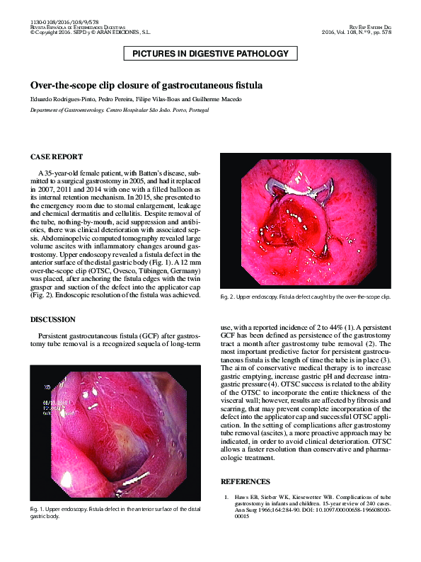 (PDF) Over-the-scope clip closure of gastrocutaneous fistula