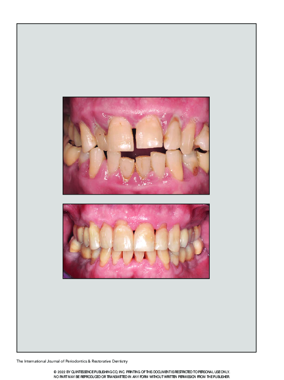 (PDF) Combined Periodontal and Orthodontic Treatment of Severely ...
