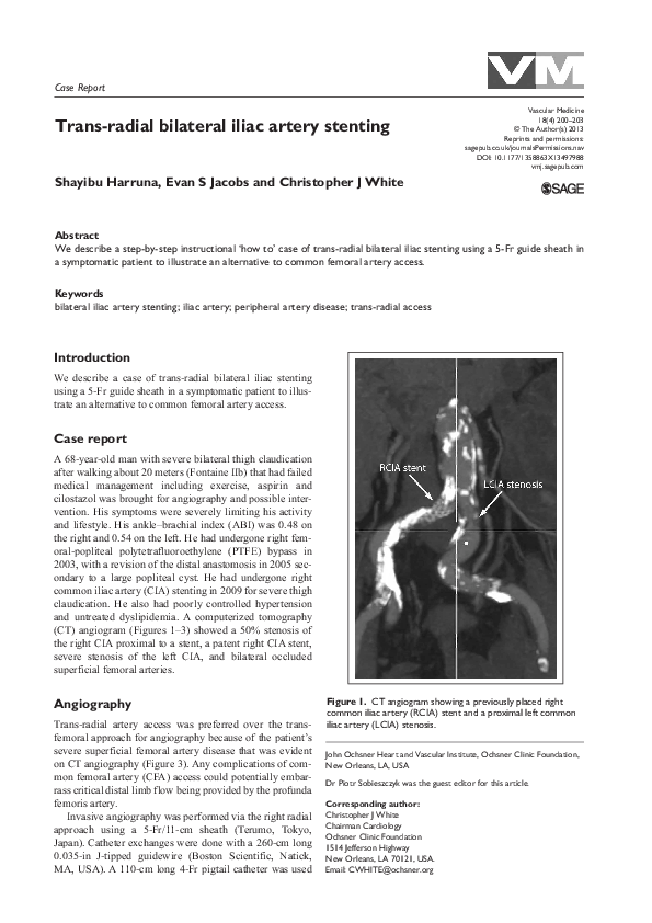 (PDF) Trans-radial bilateral iliac artery stenting | Christopher J ...