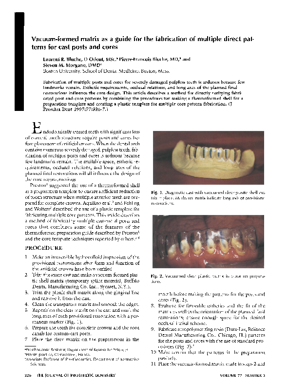 (PDF) Vacuum-formed matrix as a guide for the fabrication of multiple ...