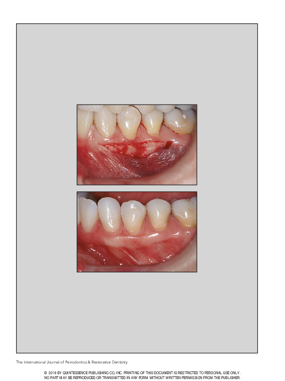 (PDF) The Modified Apically Repositioned Flap Technique: A Long-Term (4 ...