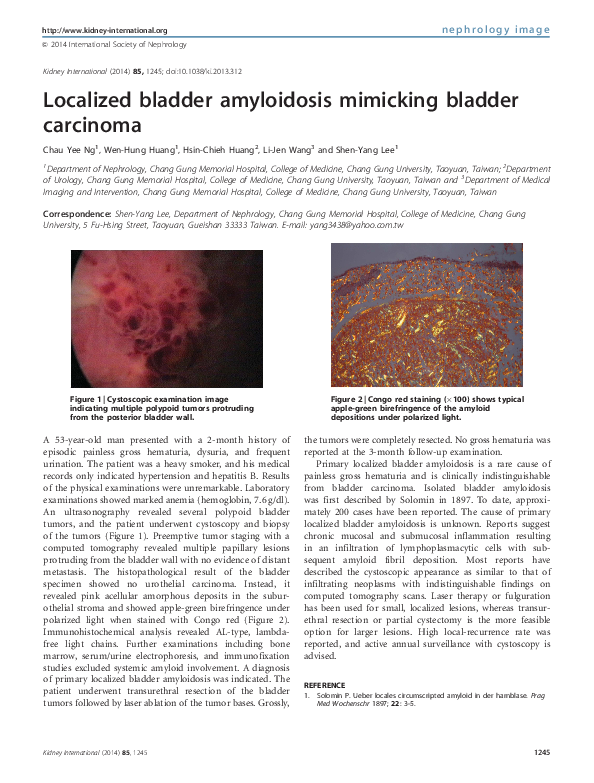 (PDF) Localized bladder amyloidosis mimicking bladder carcinoma