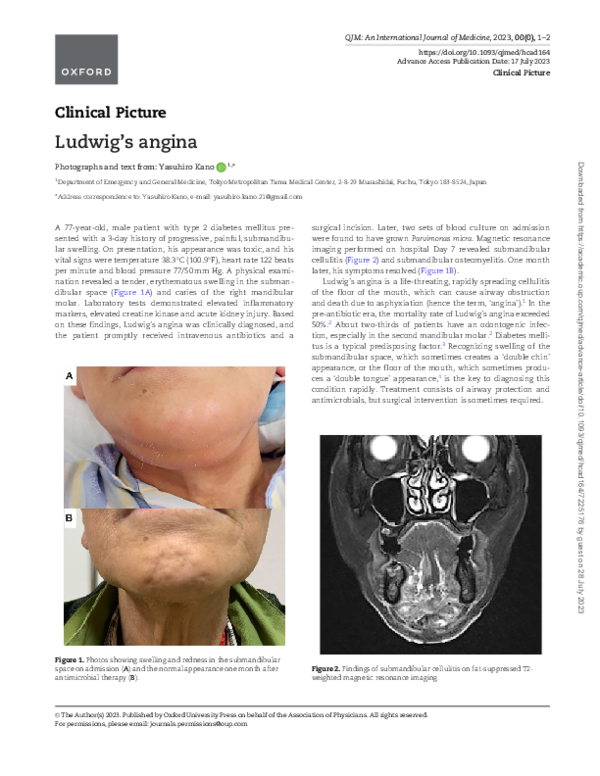 (PDF) Ludwig’s angina