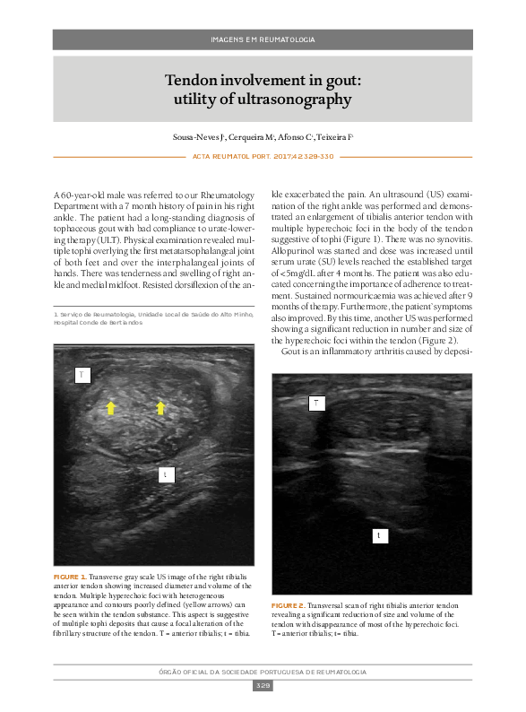 (PDF) Tendon involvement in gout: utility of ultrasonography | Marcos ...