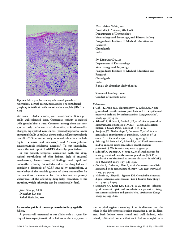(PDF) An annular patch of the scalp reveals tertiary syphilis
