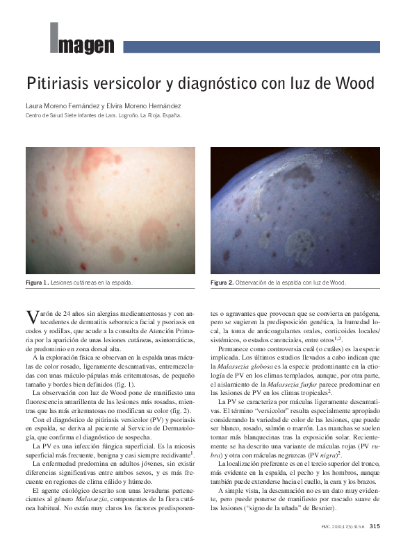 (PDF) Pitiriasis versicolor y diagnóstico con luz de Wood