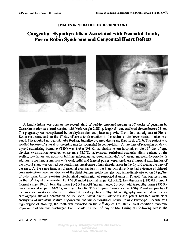 (PDF) Congenital Hypothyroidism Associated with Neonatal Tooth, Pierre ...