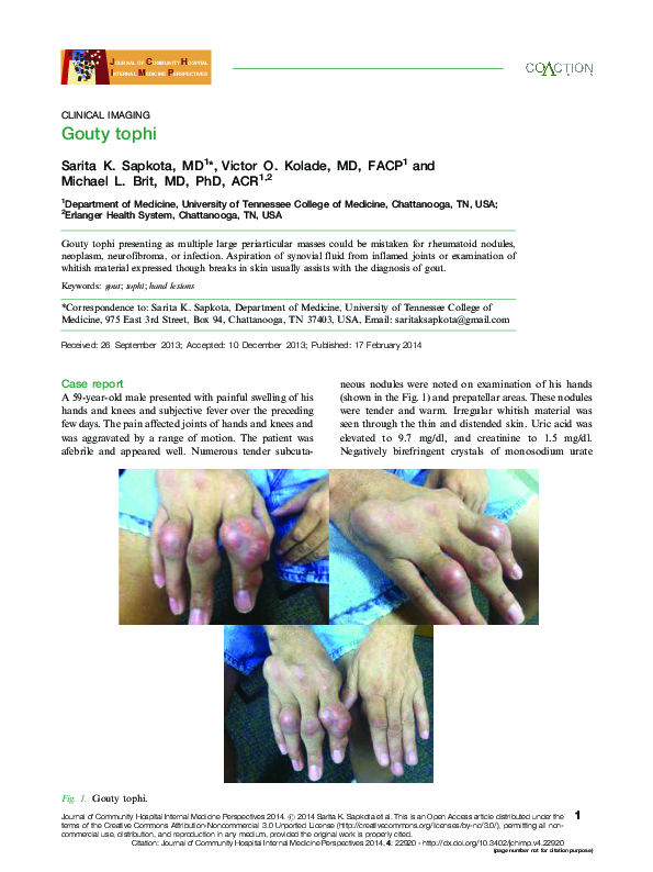 (PDF) Gouty tophi | Victor Kolade - Academia.edu
