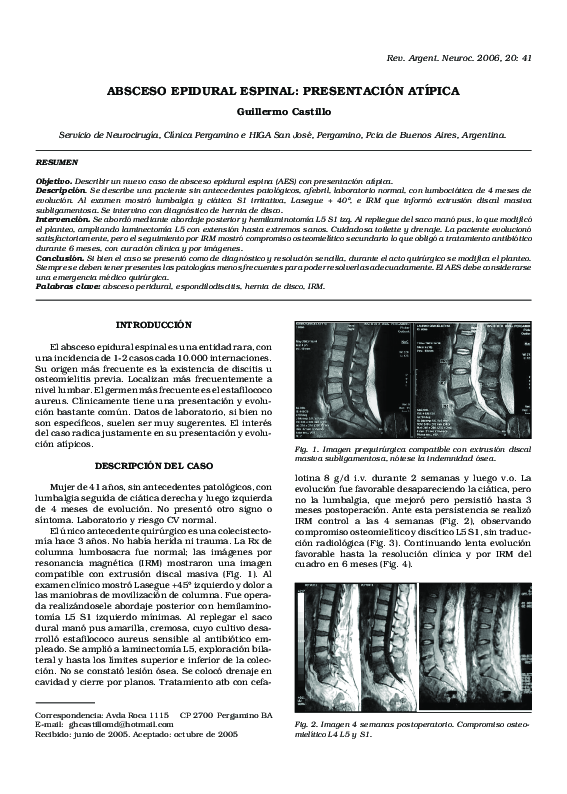 (PDF) Absceso epidural espinal: presentación atípica