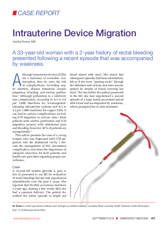 (PDF) Intrauterine Device Migration