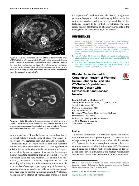 (PDF) Bladder Protection with Continuous Infusion of Warmed Saline ...