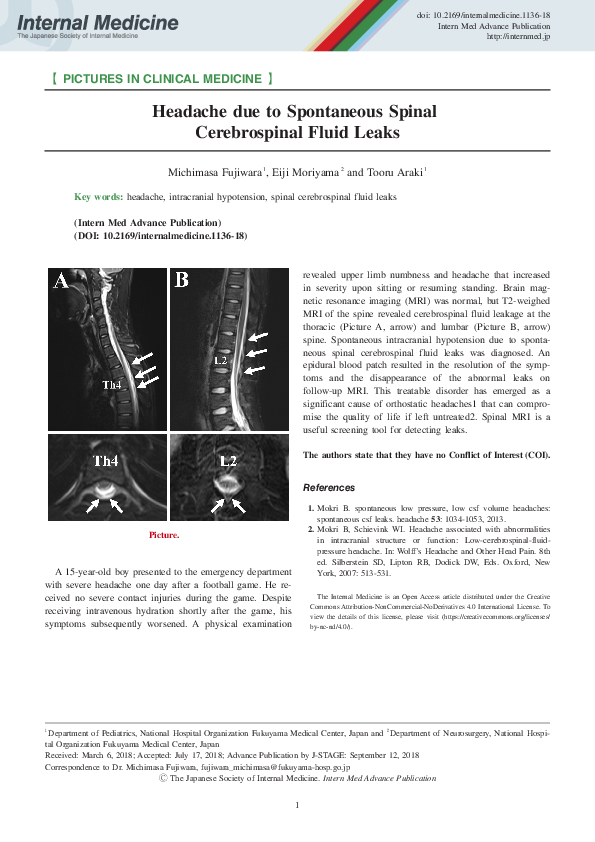 (PDF) Headache due to spontaneous spinal cerebrospinal fluid leak ...