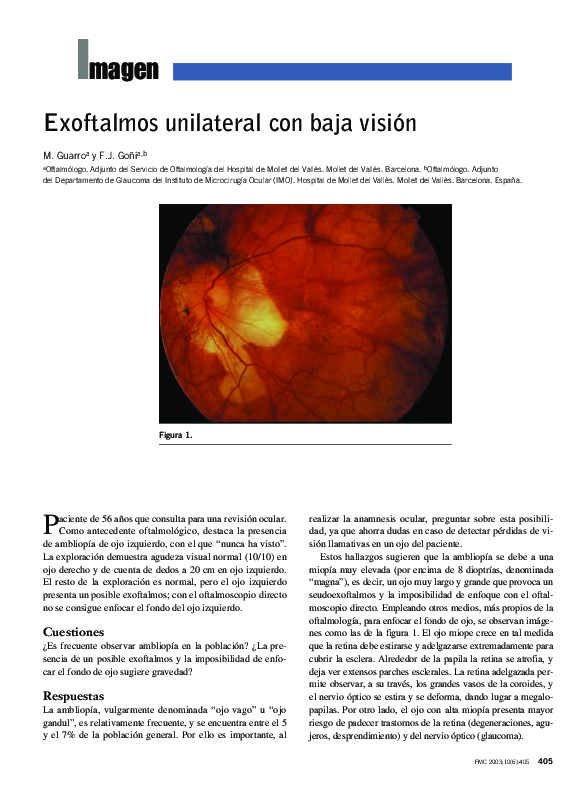 (PDF) Exoftalmos unilateral con baja visión