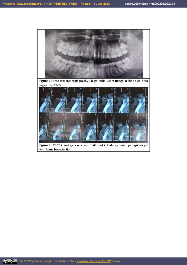 (PDF) Interdisciplinary Management of Radicular Cyst in Anterior ...