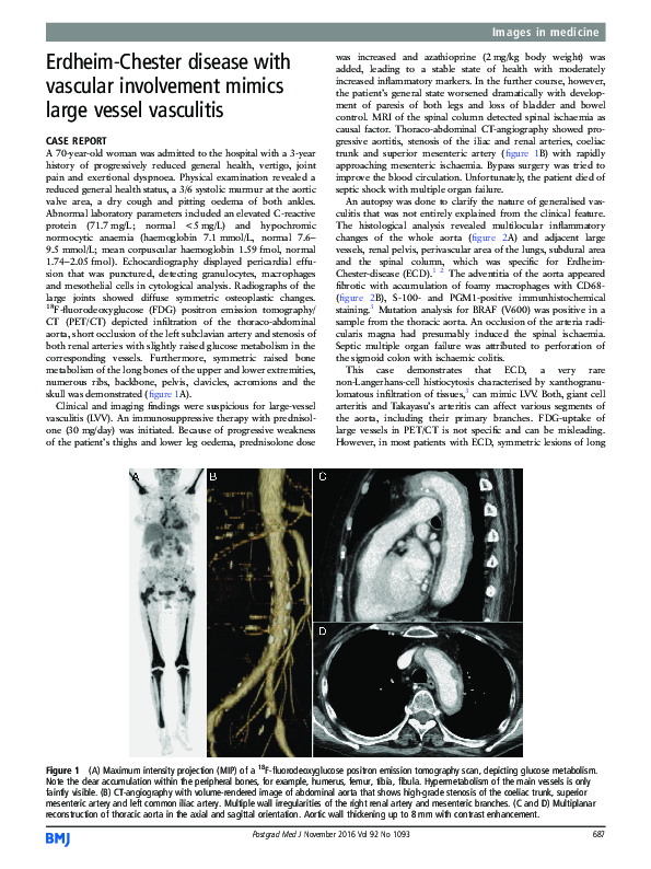 (PDF) Erdheim-Chester disease with vascular involvement mimics large ...