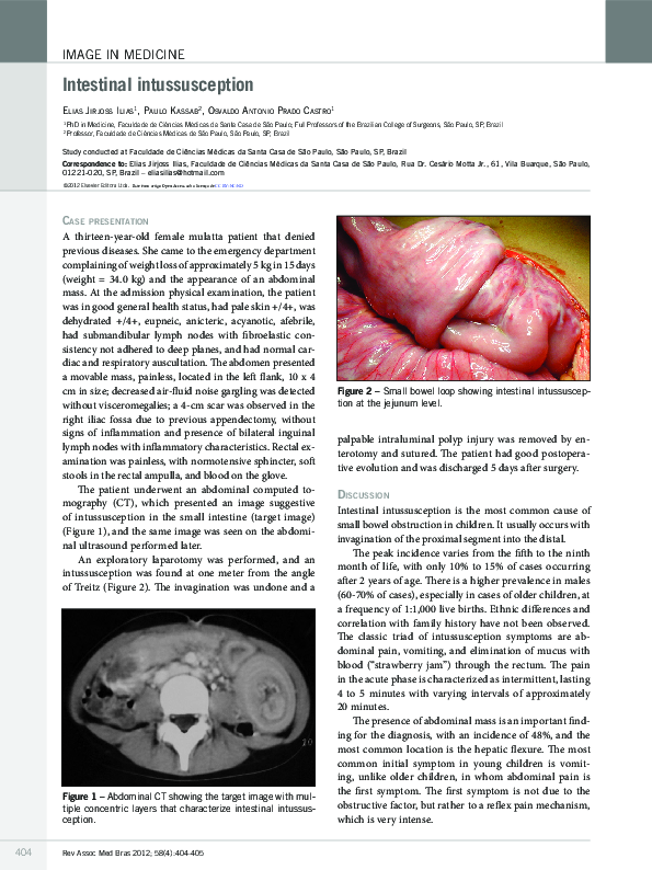 (PDF) Intestinal intussusception
