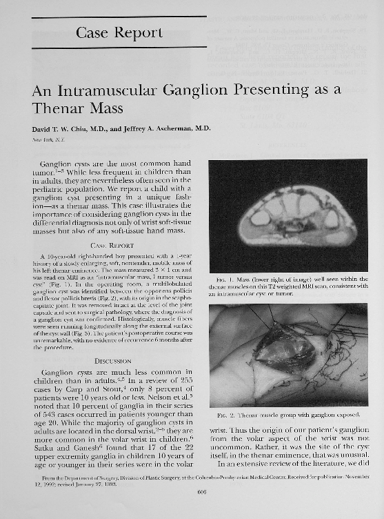 (PDF) An Intramuscular Ganglion Presenting as a Thenar Mass