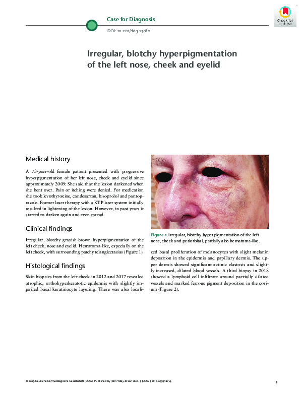 (PDF) Irregular, blotchy hyperpigmentation of the left nose, cheek and ...
