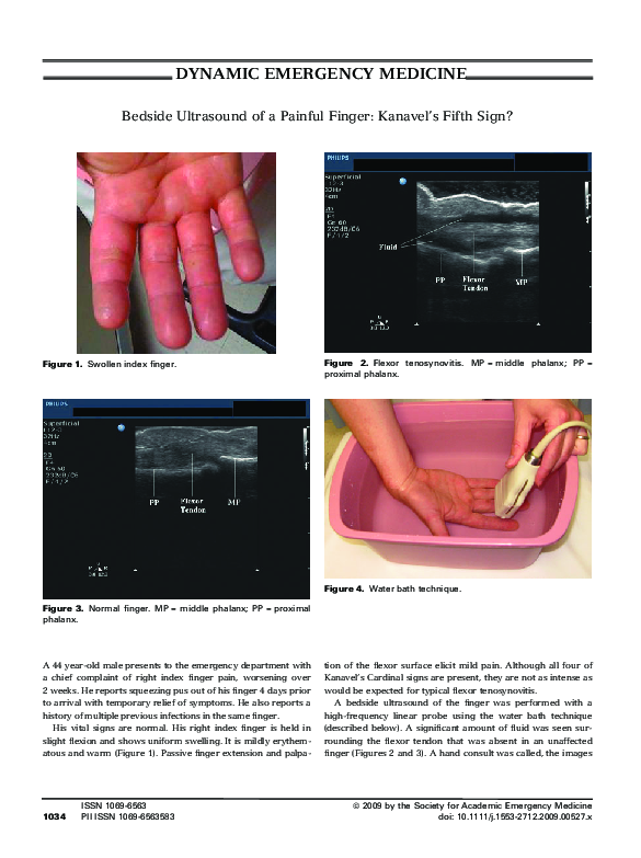 (PDF) Bedside Ultrasound of a Painful Finger: Kanavel’s Fifth Sign?