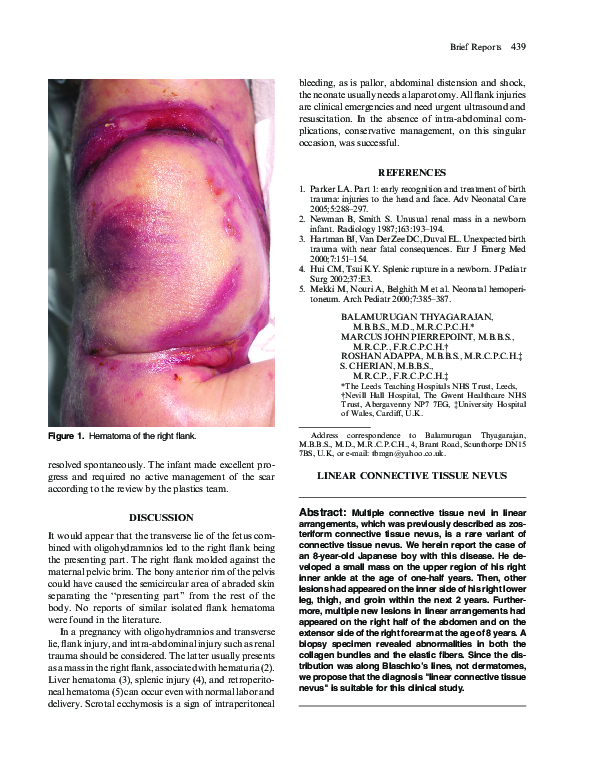 (PDF) Linear Connective Tissue Nevus