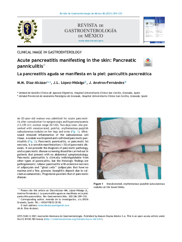 (PDF) Acute pancreatitis manifesting in the skin: Pancreatic panniculitis