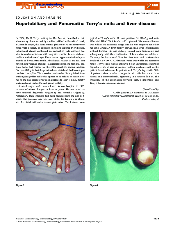 (PDF) Hepatobiliary and Pancreatic: Terry's nails and liver disease