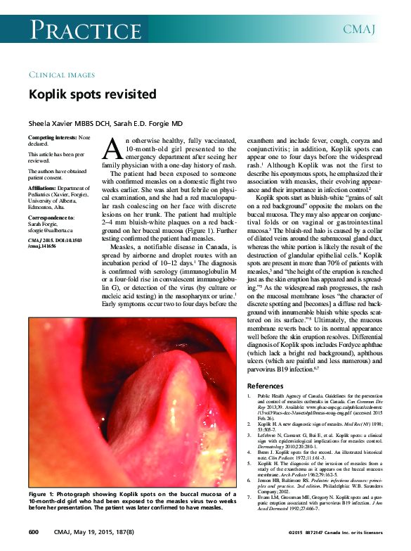 (PDF) Koplik spots revisited | Sheela Rajesh - Academia.edu