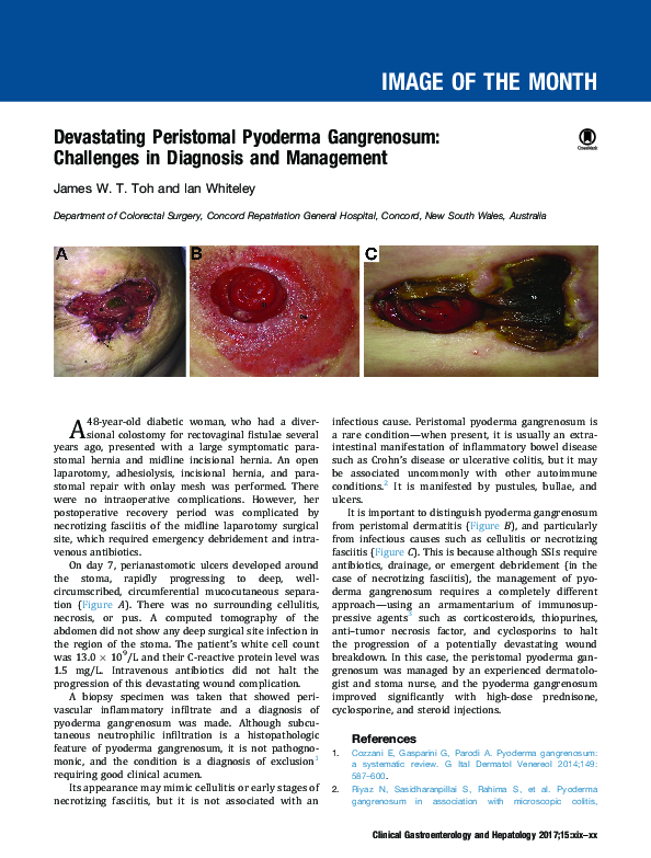 (PDF) Devastating Peristomal Pyoderma Gangrenosum: Challenges in ...