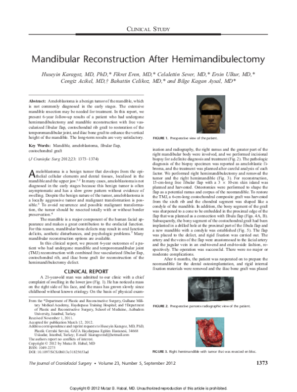 (PDF) Mandibular Reconstruction After Hemimandibulectomy