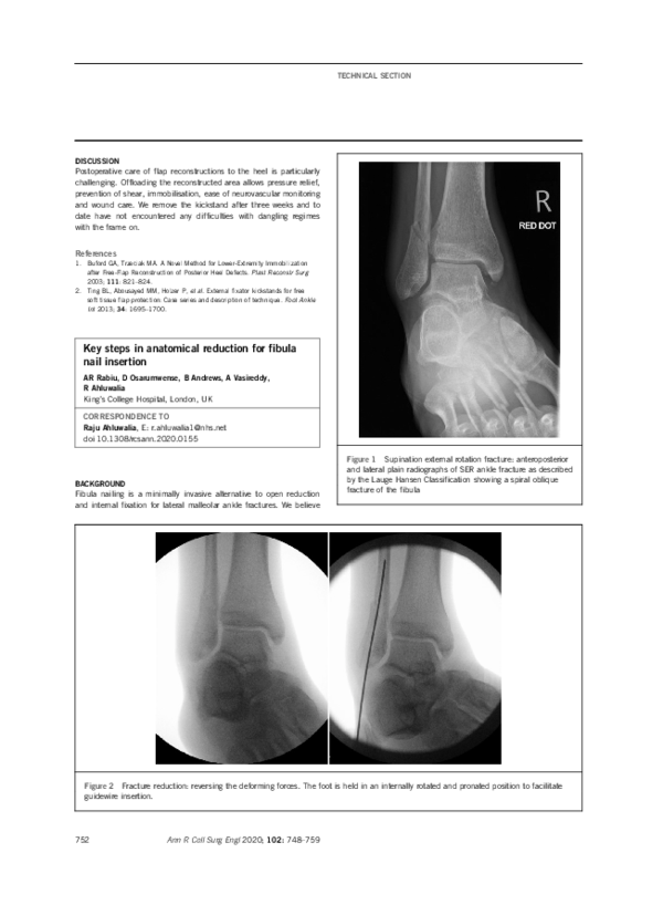 (PDF) Key steps in anatomical reduction for fibula nail insertion ...