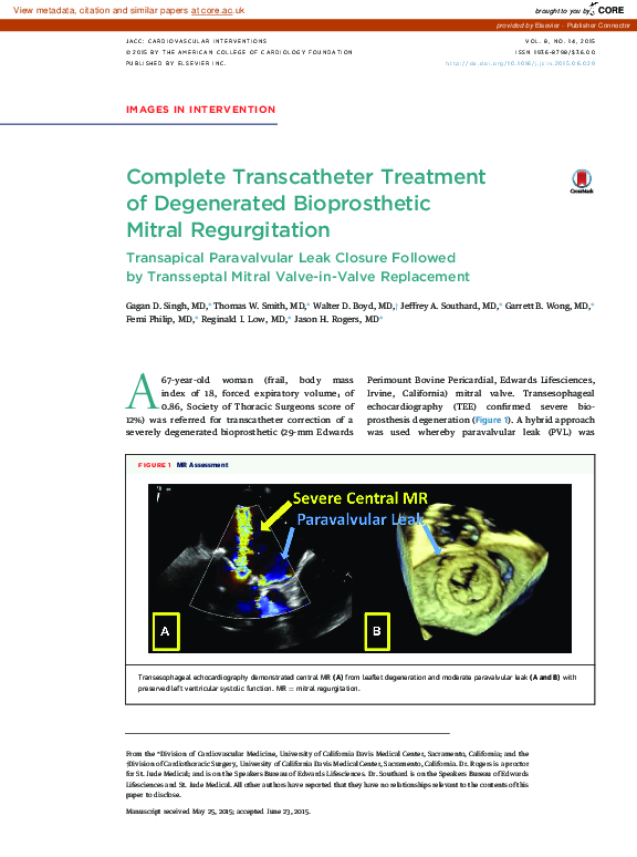 (PDF) Complete Transcatheter Treatment of Degenerated Bioprosthetic Mitral Regurgitation ...