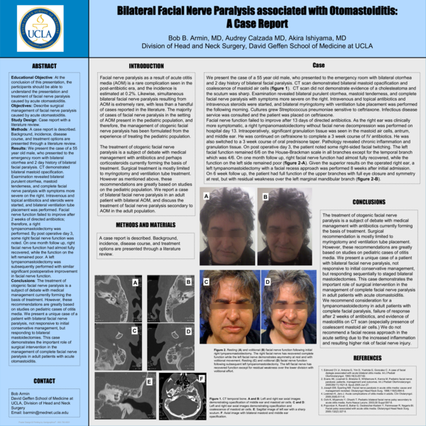 (PDF) Bilateral Facial Nerve Paralysis associated with Otomastoiditis ...