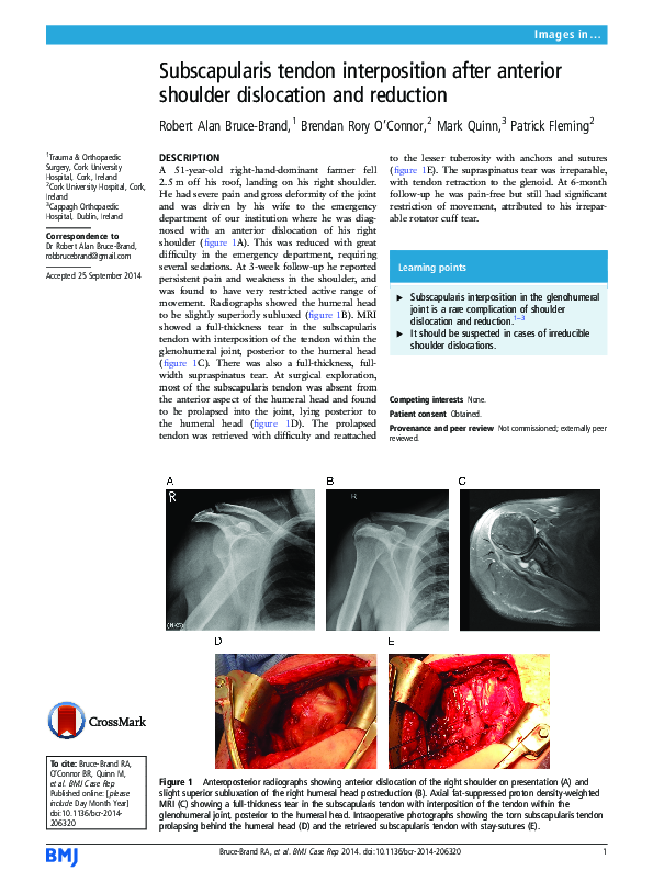 (PDF) Subscapularis tendon interposition after anterior shoulder ...