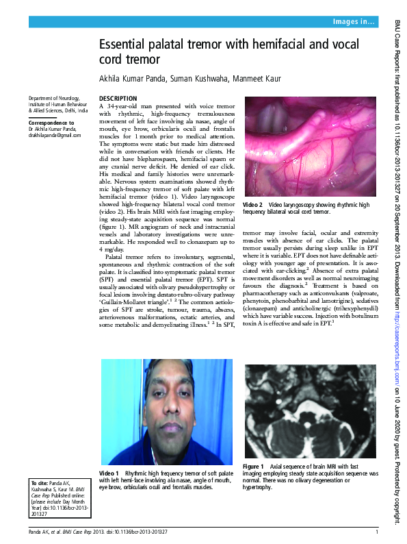 (PDF) Essential palatal tremor with hemifacial and vocal cord tremor