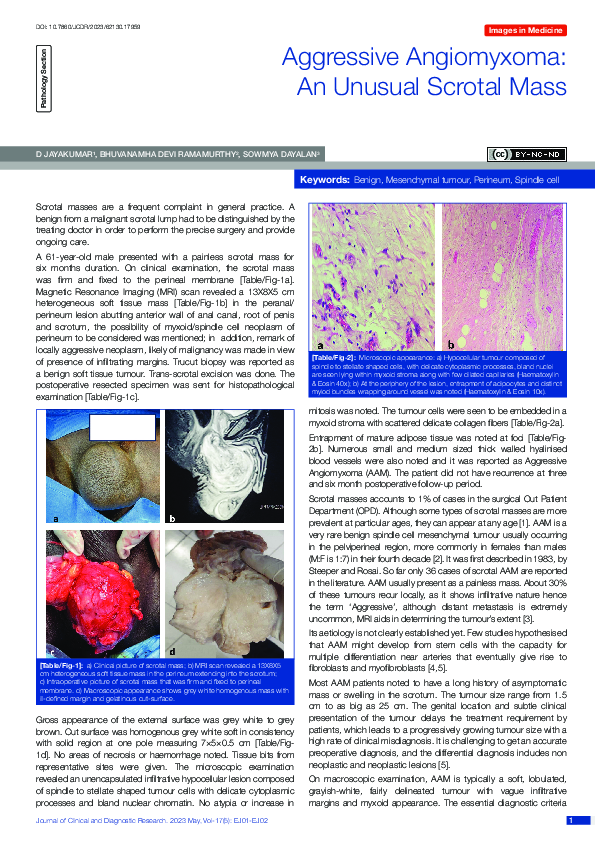 (PDF) Aggressive Angiomyxoma: An Unusual Scrotal Mass | Bhuvanamha Devi ...