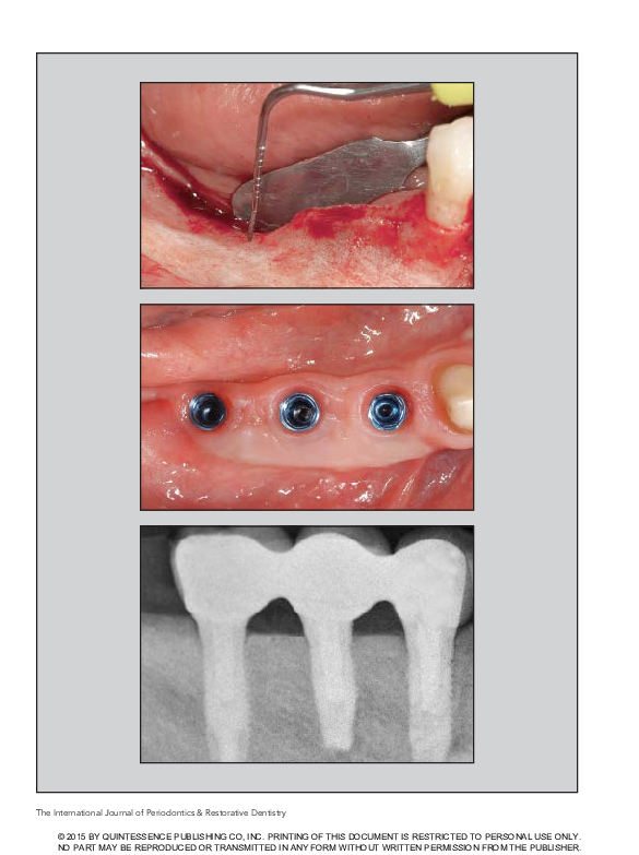 (PDF) Osseointegrated Implants in Vertical Ridge Augmentation with a ...