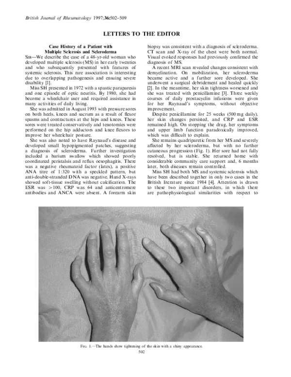 (PDF) Case history of a patient with multiple sclerosis and scleroderma