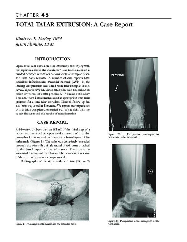 (PDF) Total Talar Extrusion: A Case Report