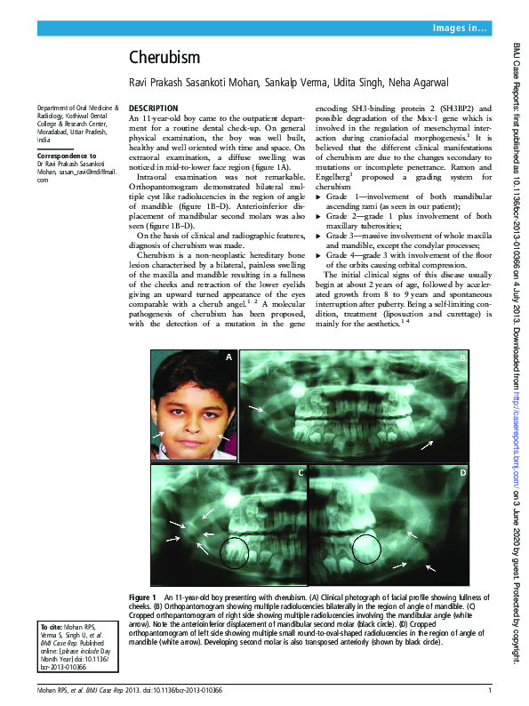 (PDF) Cherubism