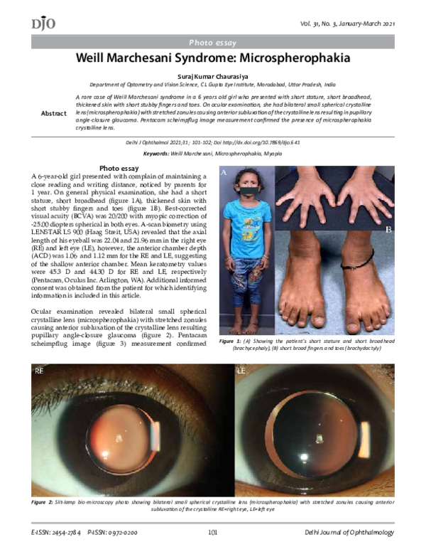 (PDF) Weill Marchesani Syndrome: Microspherophakia