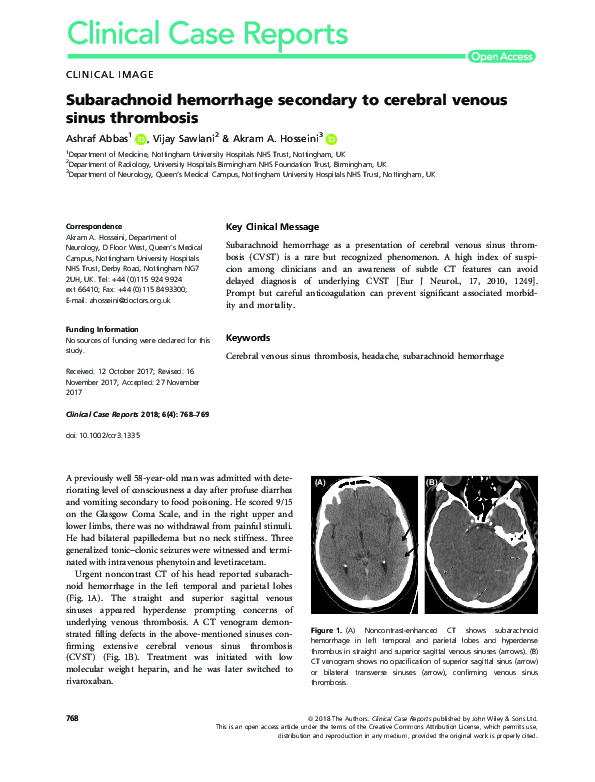 (PDF) Subarachnoid hemorrhage secondary to cerebral venous sinus ...