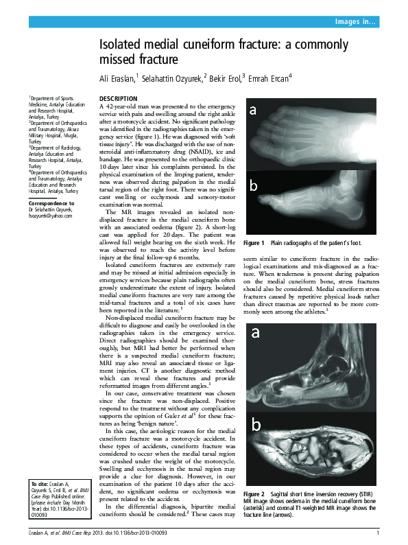 (PDF) Isolated medial cuneiform fracture: a commonly missed fracture