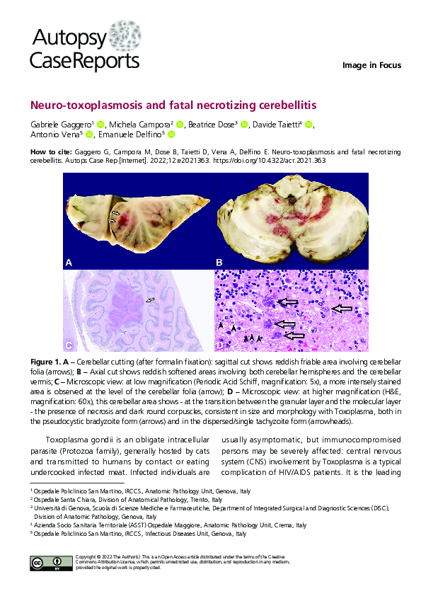 (PDF) Neuro-toxoplasmosis and fatal necrotizing cerebellitis