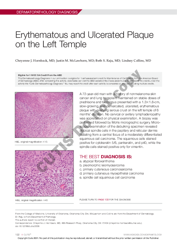 (PDF) Erythematous and Ulcerated Plaque on the Left Temple