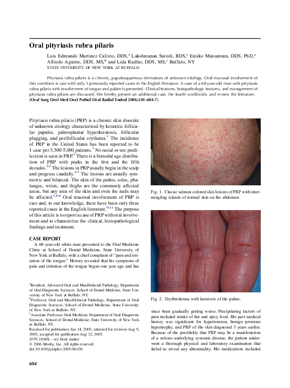 (PDF) Oral pityriasis rubra pilaris | Luis Edmundo Martinez Calixto ...
